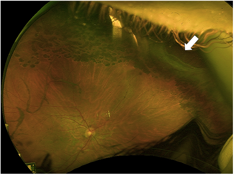 ‘Failure’ of laser prophylaxis in an eye with stickler syndrome ...