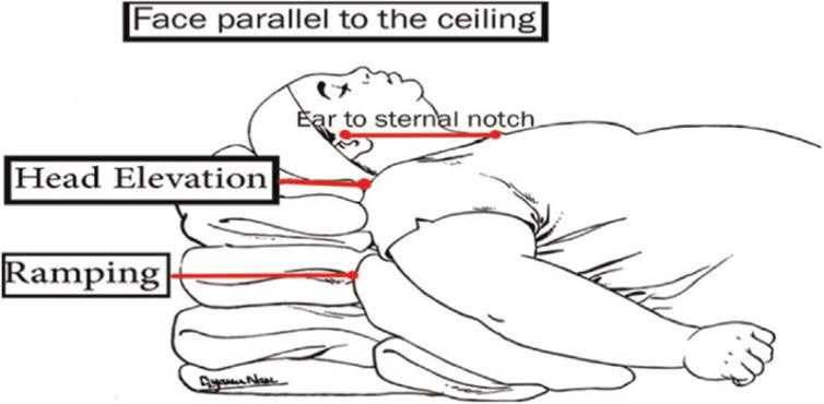 A difficult airway made worse by apprehension: an obese young male with ...