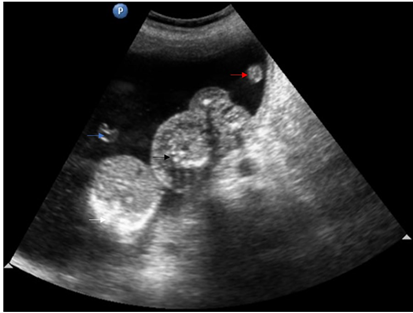 Twin reversed arterial perfusion (TRAP) sequence in a monochorionic ...