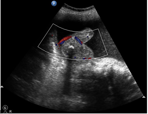 Twin reversed arterial perfusion (TRAP) sequence in a monochorionic ...