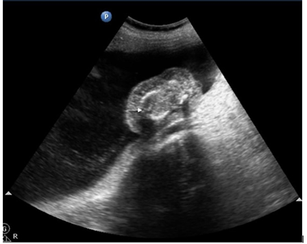 Twin reversed arterial perfusion (TRAP) sequence in a monochorionic ...