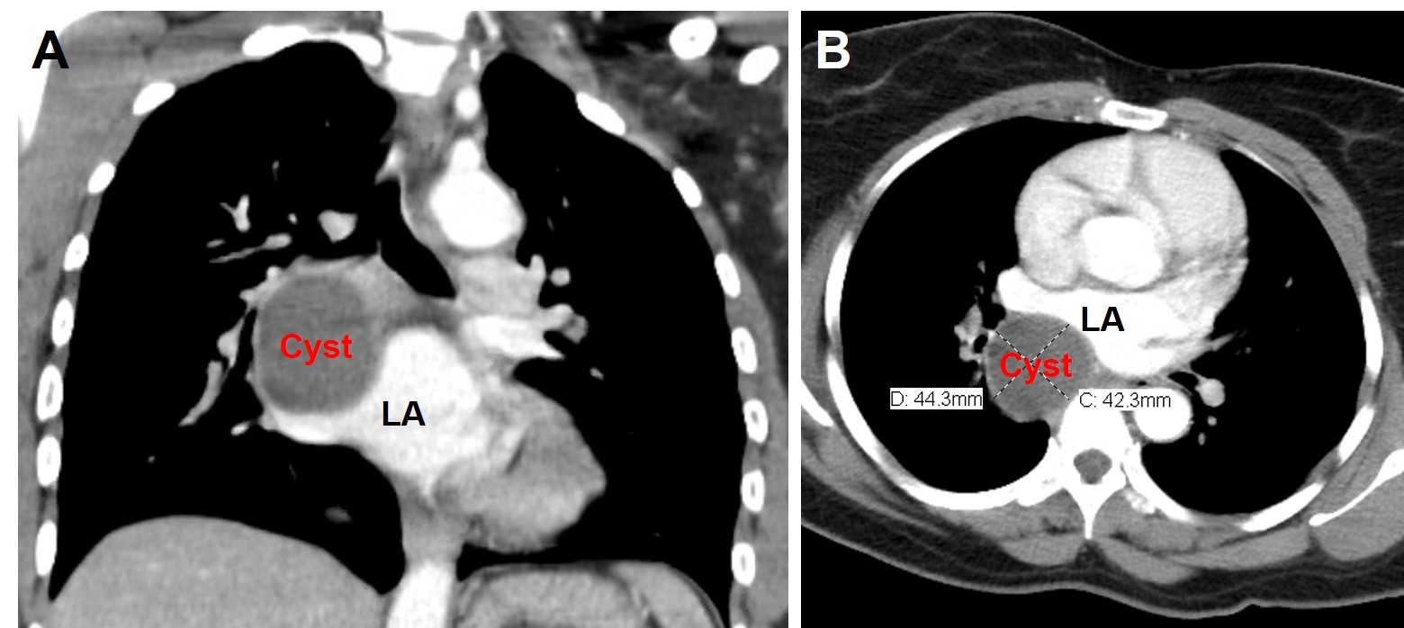 Extrapericardial bronchogenic cyst associated with atrial fibrillation ...