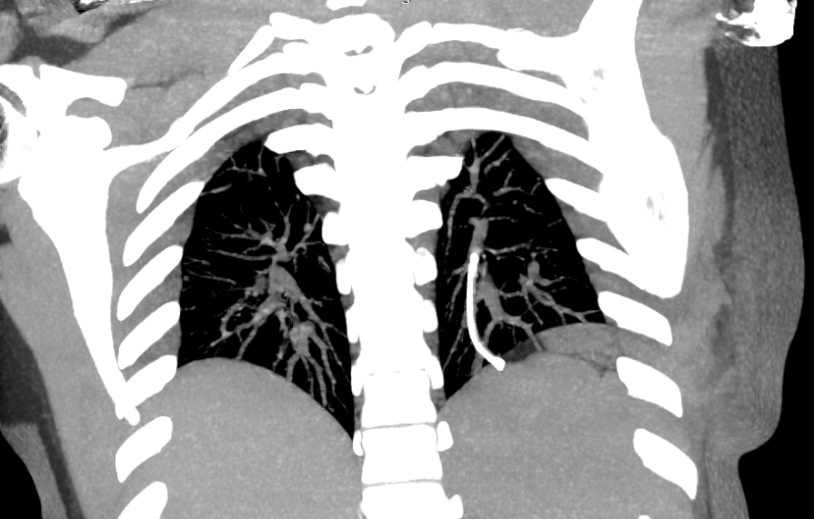 Spontaneous fragmentation and embolization of chemoport catheter- a ...