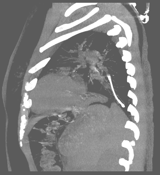 Spontaneous fragmentation and embolization of chemoport catheter- a ...