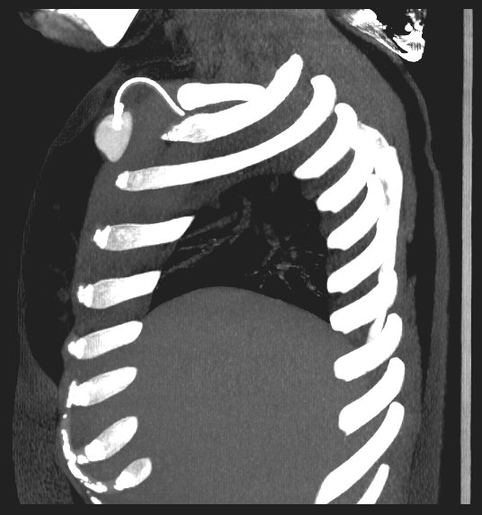 Spontaneous fragmentation and embolization of chemoport catheter- a ...