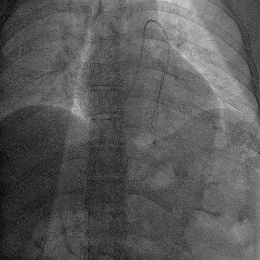 Spontaneous fragmentation and embolization of chemoport catheter- a ...