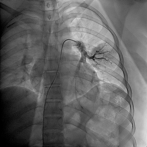 Spontaneous fragmentation and embolization of chemoport catheter- a ...