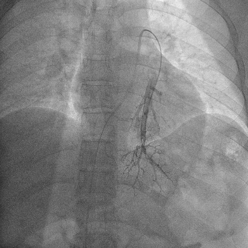 Spontaneous fragmentation and embolization of chemoport catheter- a ...