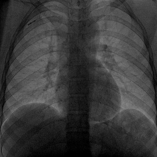 Spontaneous fragmentation and embolization of chemoport catheter- a ...