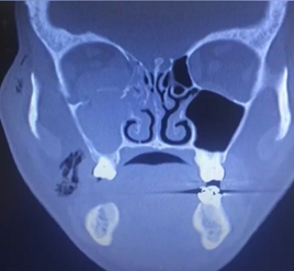 Retrobulbar Hematoma after an open reduction of blow-out fracture of ...