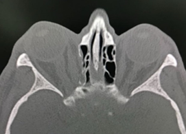 Retrobulbar Hematoma after an open reduction of blow-out fracture of ...