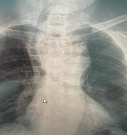 Endothoracic goiter as a cause of dyspnea: case report - MedCrave online