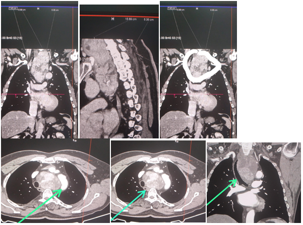 Endothoracic goiter as a cause of dyspnea: case report - MedCrave online
