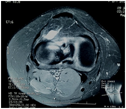Ganglion Cyst of the Hoffa Fat Pad - MedCrave online