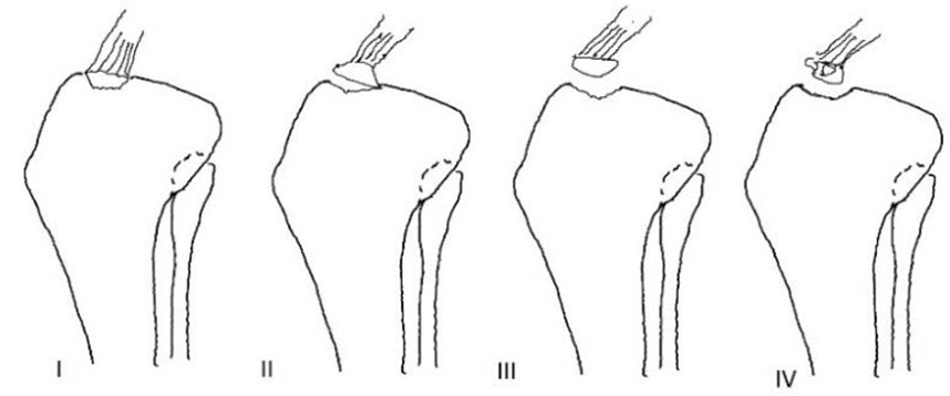 Staple arthroscopic fixation of tibial ACL avulsion with concomitant ...