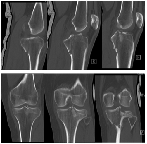 Staple arthroscopic fixation of tibial ACL avulsion with concomitant ...
