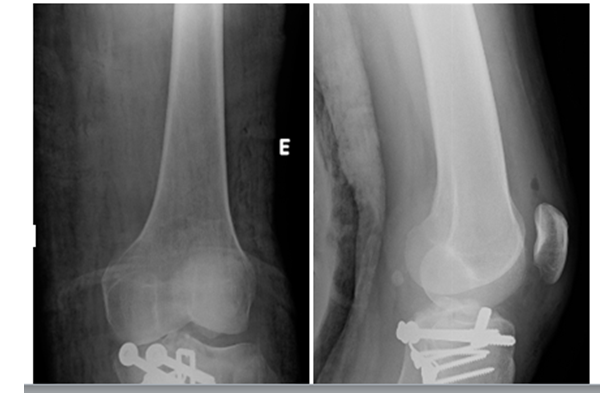 Staple arthroscopic fixation of tibial ACL avulsion with concomitant ...