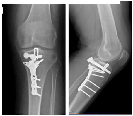 Staple arthroscopic fixation of tibial ACL avulsion with concomitant ...