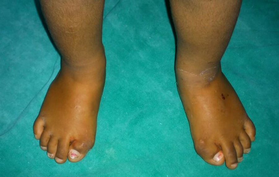 Fibrodysplasia ossificans progressiva - a case report with brief ...