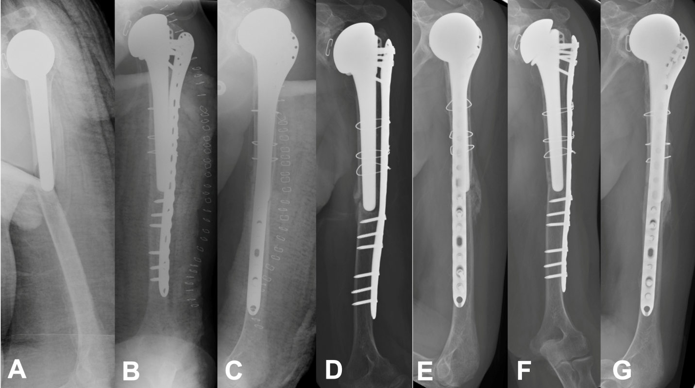 Surgical treatments of patients with periprosthetic humeral fracture ...