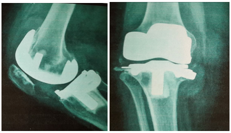 Failure due to metallosis after cruciate retaining total knee ...