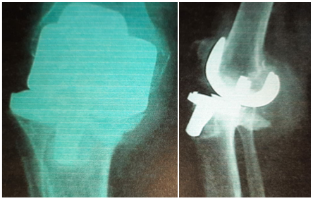 Failure due to metallosis after cruciate retaining total knee ...