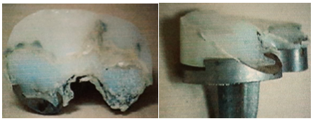 Failure due to metallosis after cruciate retaining total knee ...