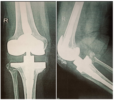 Failure due to metallosis after cruciate retaining total knee ...