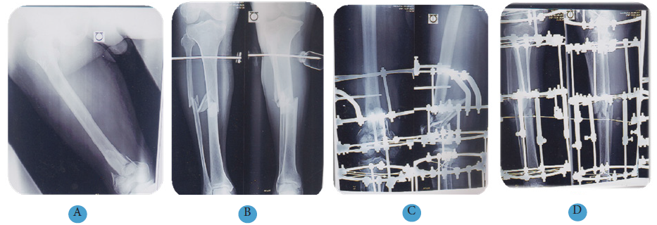 Modified Judet’s Quadricepsplasty with patella traction for extension ...