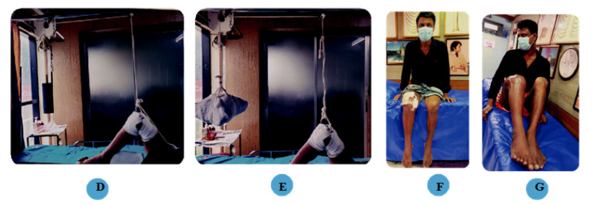 Modified Judet’s Quadricepsplasty with patella traction for extension ...