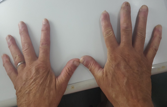 Ulcerating variety of carpal tunnel syndrome mimicking scleroderma ...