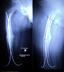 Study on outcome of treatment of paediatric femoral shaft fracture by titanium elastic nails ...