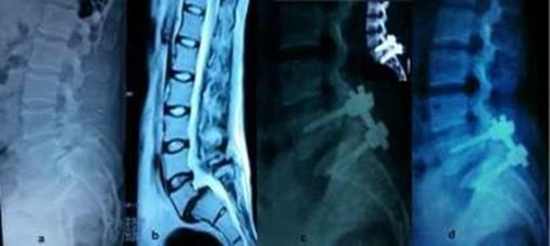 Study on lumbar interbody fusion and posterior instrumentation in ...