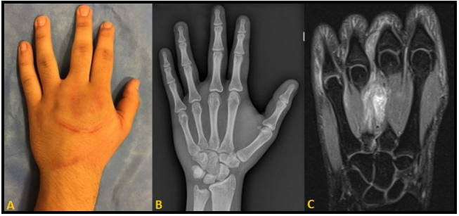Nonsurgical treatment of deep transverse metacarpal ligament injuries ...
