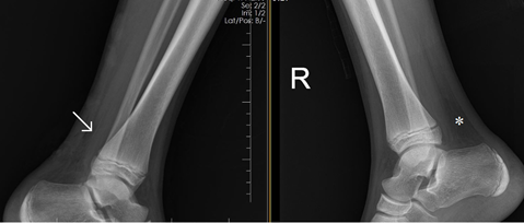 Pediatric Achilles tendon laceration: a case report and systematic ...