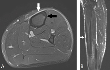 Medial Tibial Stress Syndrome–Magnetic resonance imaging diagnosis in a ...