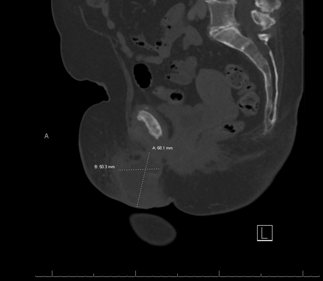 Recurrent pubic osteomyelitis secondary to vulvar abscess in a post ...