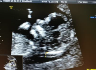 Incomplete mole in term pregnancy: a case report and literature review ...