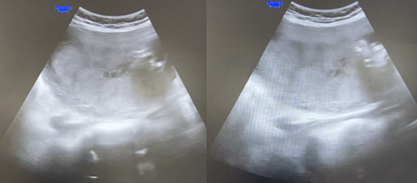 Traumatic abruption secondary to physical violence in the setting of ...